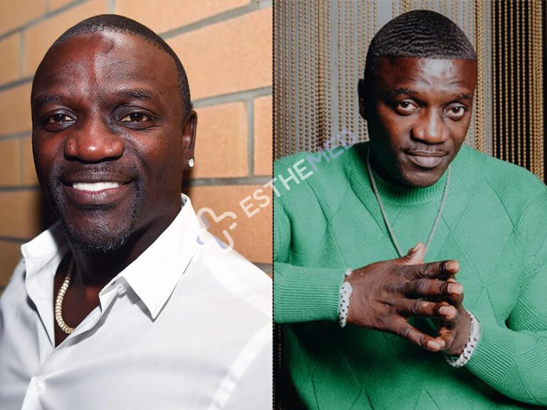 Akon Hair Transplant: Unveiling the Truth Behind His Hair Transformation