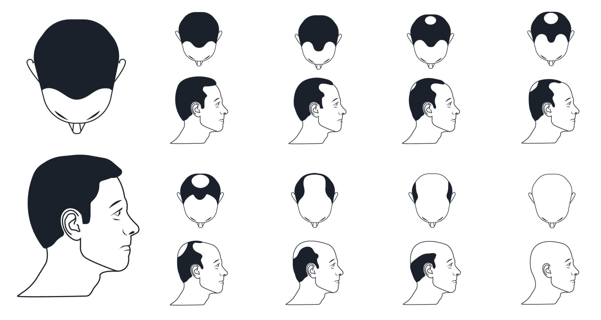 Norwood Scale: Understanding Male Pattern Baldness